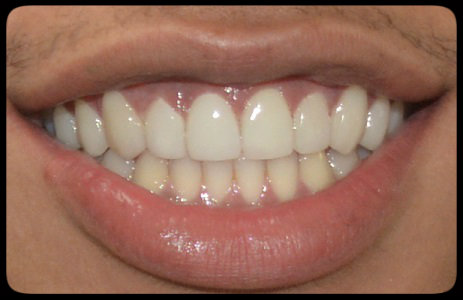 Case of the week: Smile Satisfaction | Poindexter Dental, Inc.